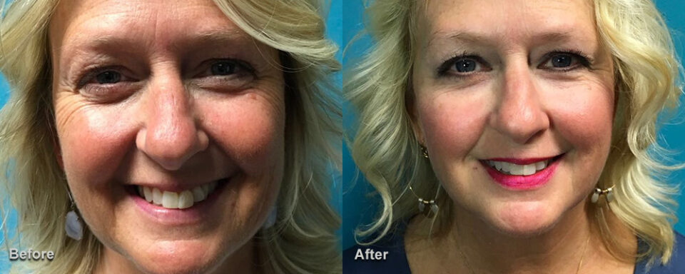 Non-Surgical Procedure Gallery | Bajaj Plastic Surgery