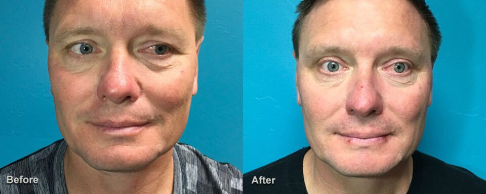 Men's Plastic Surgery Gallery | Bajaj Plastic Surgery