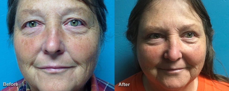 Facial Plastic Surgery Gallery Oklahoma City | Bajaj Plastic Surgery