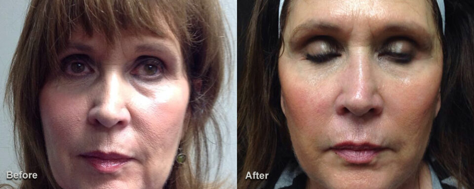 Facial Plastic Surgery Gallery Oklahoma City | Bajaj Plastic Surgery