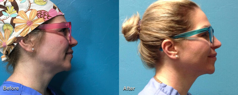 Non-Surgical Procedure Gallery | Bajaj Plastic Surgery