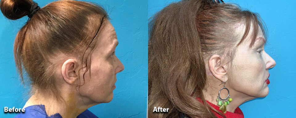 Facial Plastic Surgery Gallery Oklahoma City | Bajaj Plastic Surgery