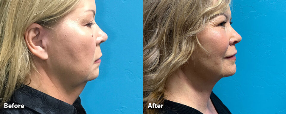 Facial Plastic Surgery Gallery Oklahoma City | Bajaj Plastic Surgery