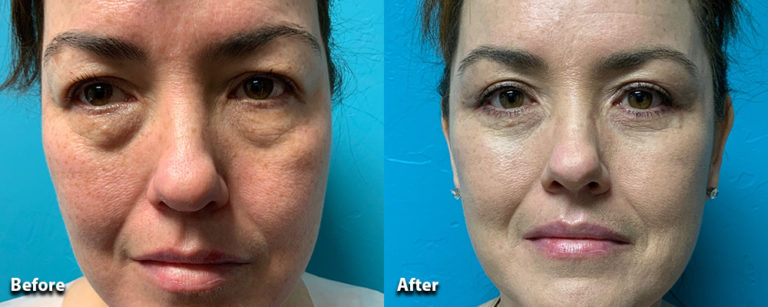 Eyelid Surgery Oklahoma City | Bajaj Plastic Surgery