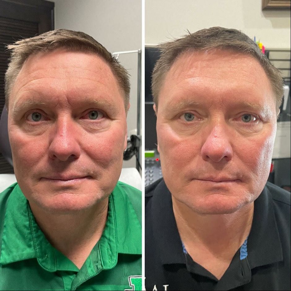 Non-Surgical Procedure Gallery | Bajaj Plastic Surgery