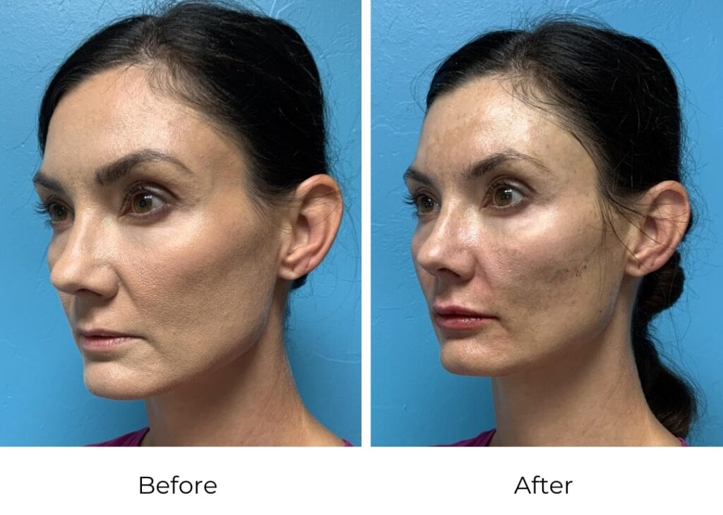 Can You Believe She Has 4 Syringes of Filler? | Bajaj Plastic Surgery