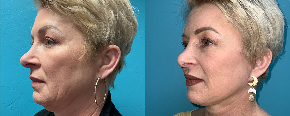 Facial Plastic Surgery Gallery Oklahoma City | Bajaj Plastic Surgery