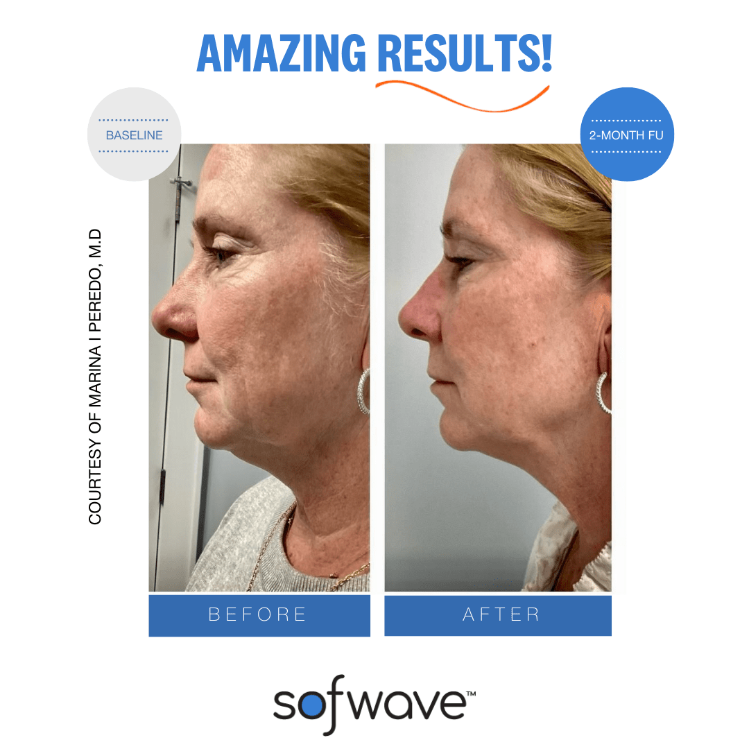 Sofwave Oklahoma City, OK | Facial Lines & Wrinkles Treatment